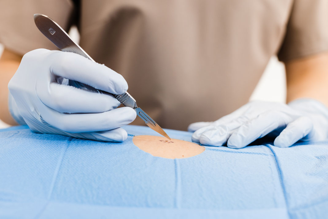 Chirurgiczne usuwanie zmiany skórnej / Biopsja diagnostyczna Olsztyn ...